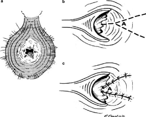 Anal Canal Resurfacing in Anal Stenosis | SpringerLink
