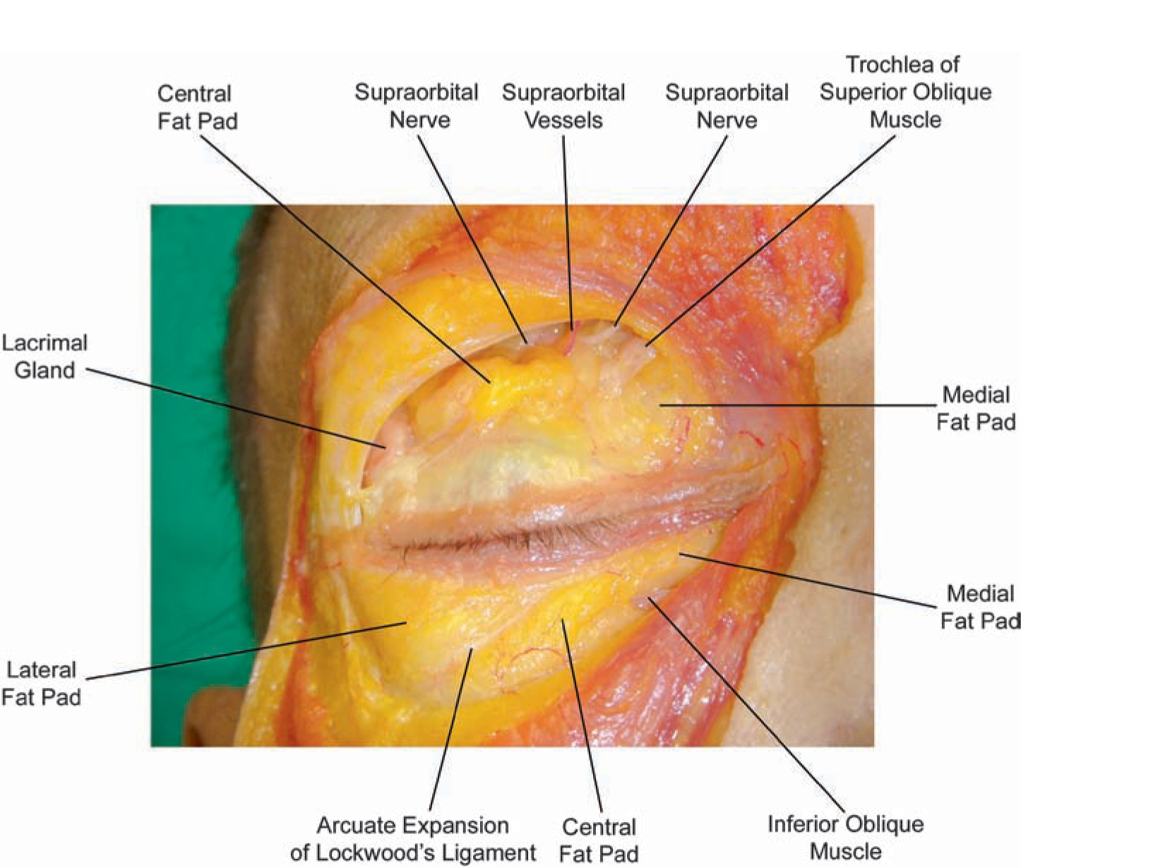 Eyelid and Periorbital Aesthetic Surgery | SpringerLink