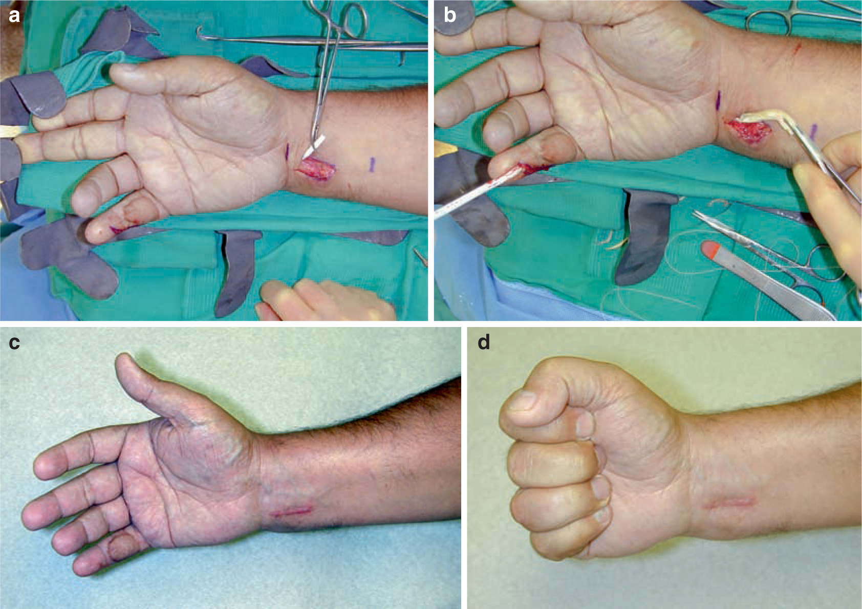 Grafts, Local and Regional Flaps | SpringerLink