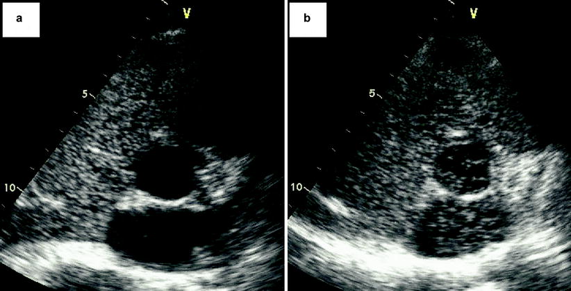 Echocardiography in the Management of Atrial Septal Defect (ASD) and ...