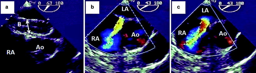 Echocardiography in the Management of Atrial Septal Defect (ASD) and ...