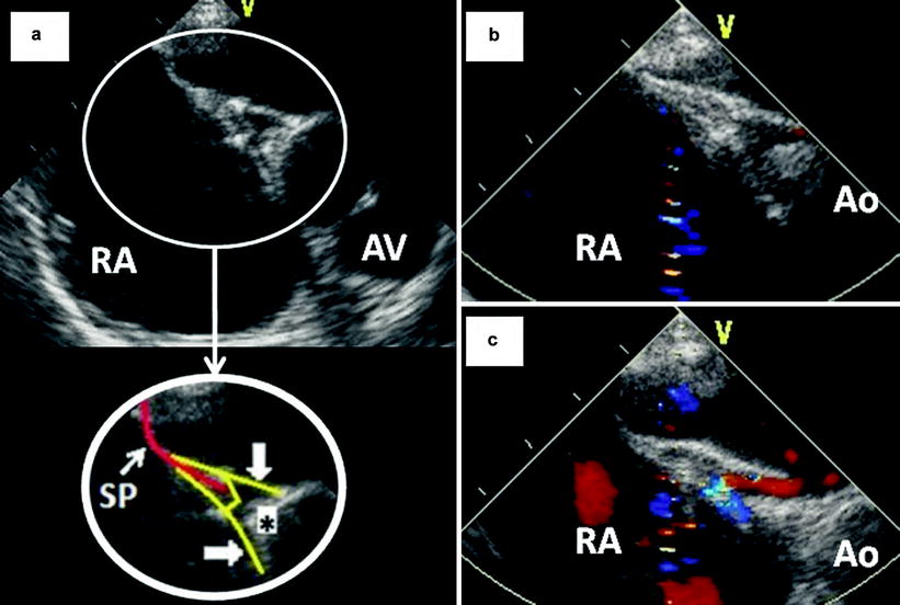 Echocardiography in the Management of Atrial Septal Defect (ASD) and ...