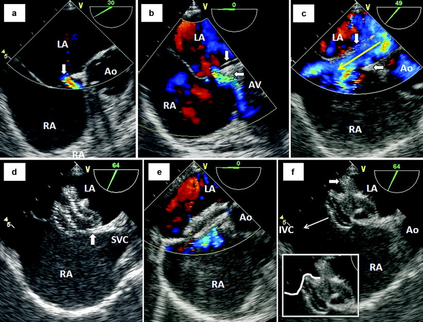 Echocardiography in the Management of Atrial Septal Defect (ASD) and ...