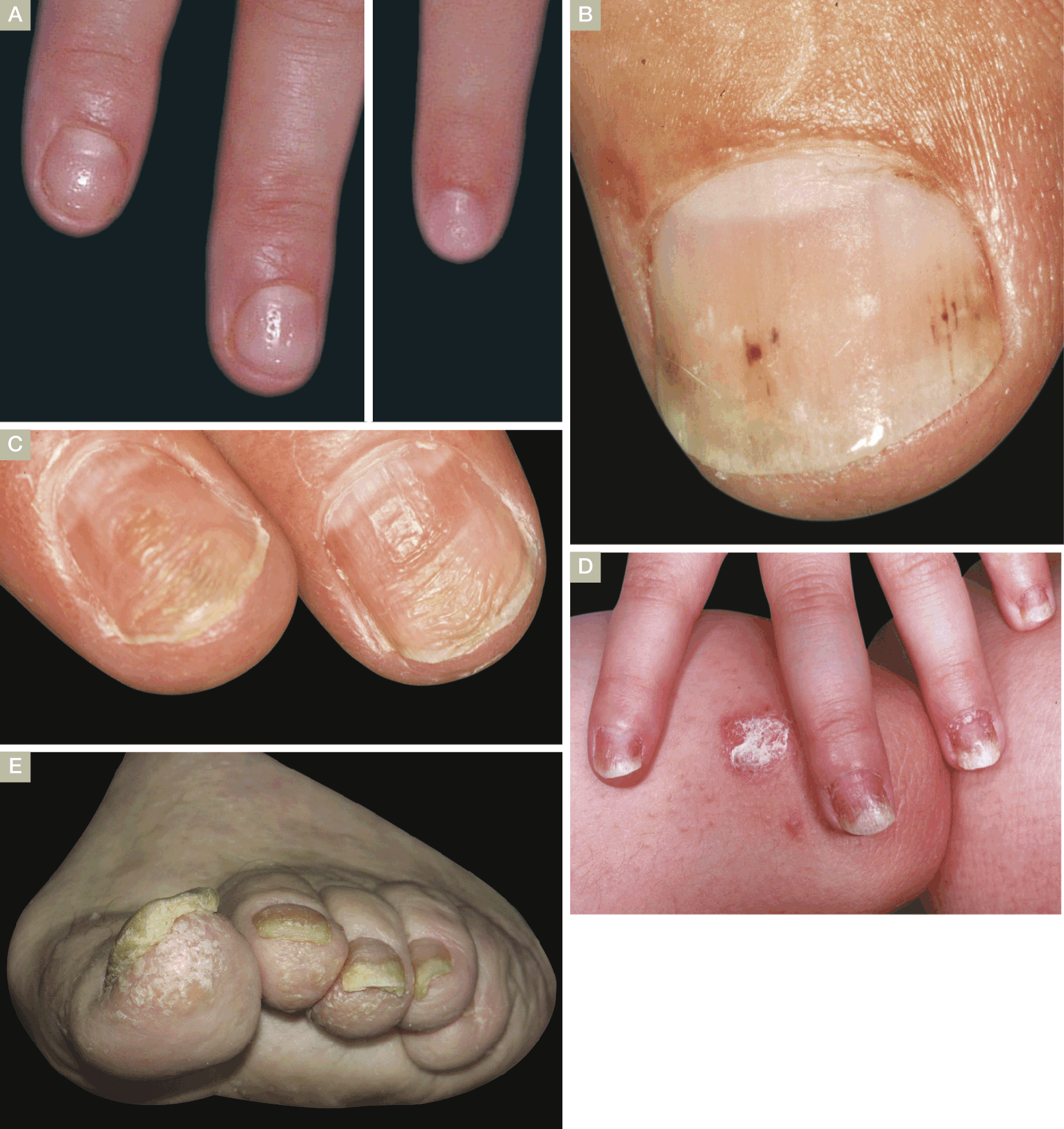 Chronic, Asymmetrical Oligo- Or Polyarthritis | SpringerLink