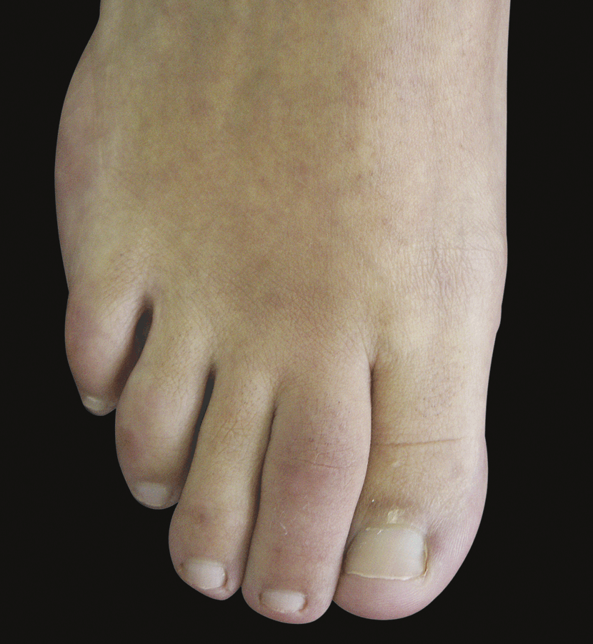 Chronic, Asymmetrical Oligo- Or Polyarthritis | SpringerLink