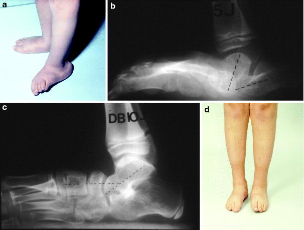 Neural Tube Defects, Spina Bifida, and Spinal Dysraphism | SpringerLink