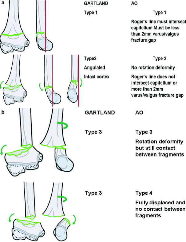 Gartland Fracture Classification | www.picswe.net