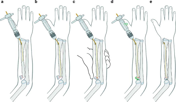 Fractures of the Elbow and Forearm | SpringerLink