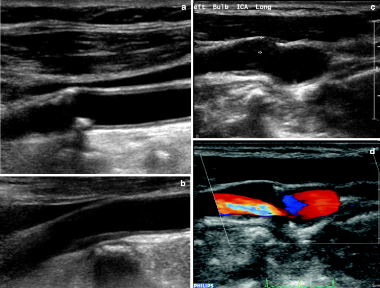 The Significance of Echolucent Plaques: Past and Future Perspectives ...