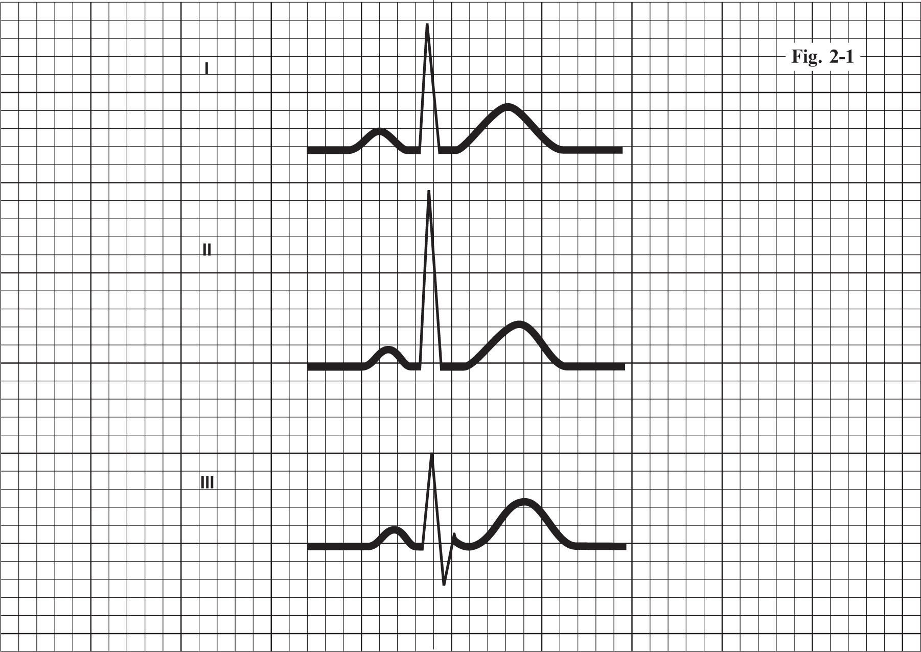 ECG Leads | SpringerLink