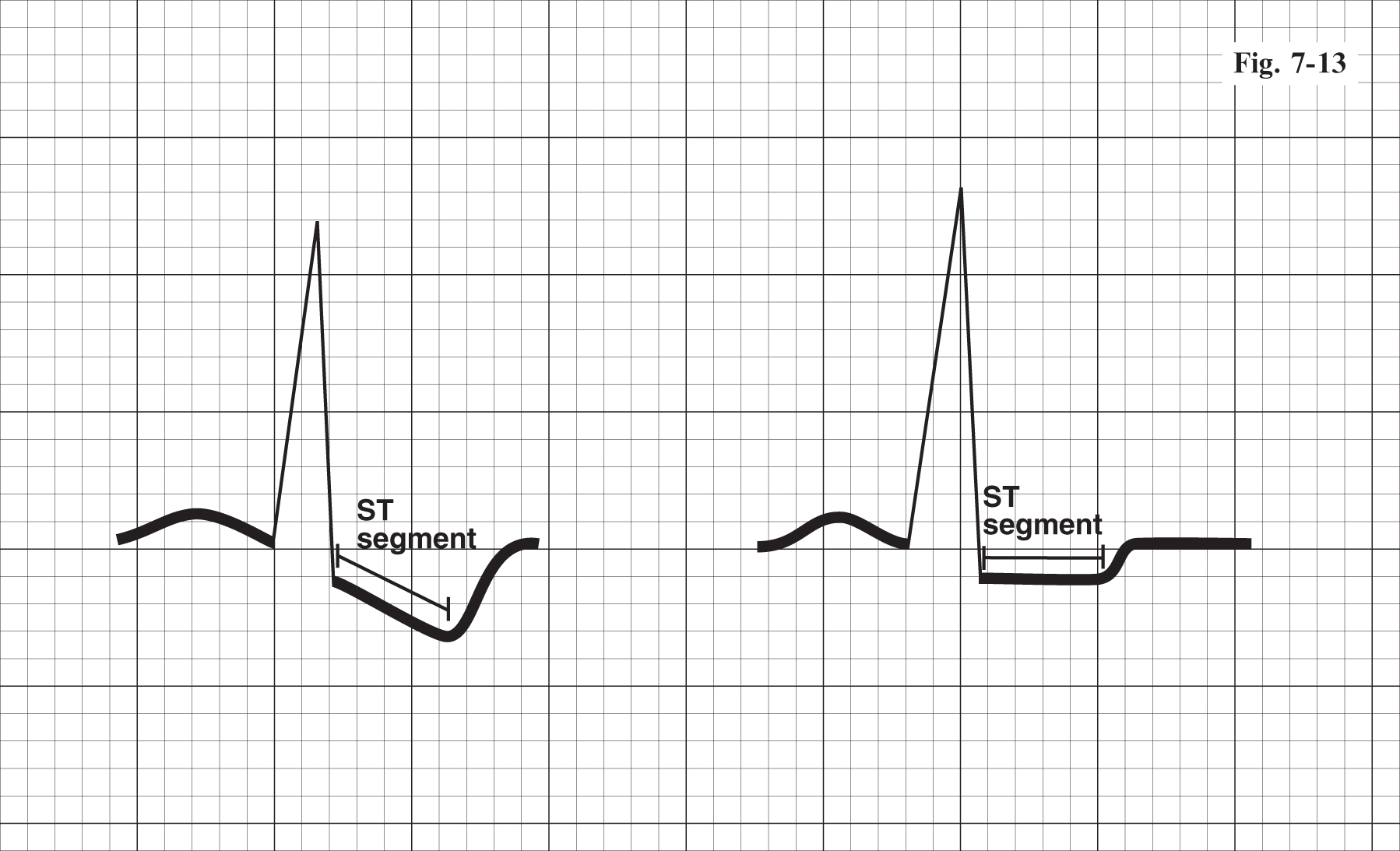 ST Segment Depression (4-Codes) and Negative T-Waves (5-Codes ...