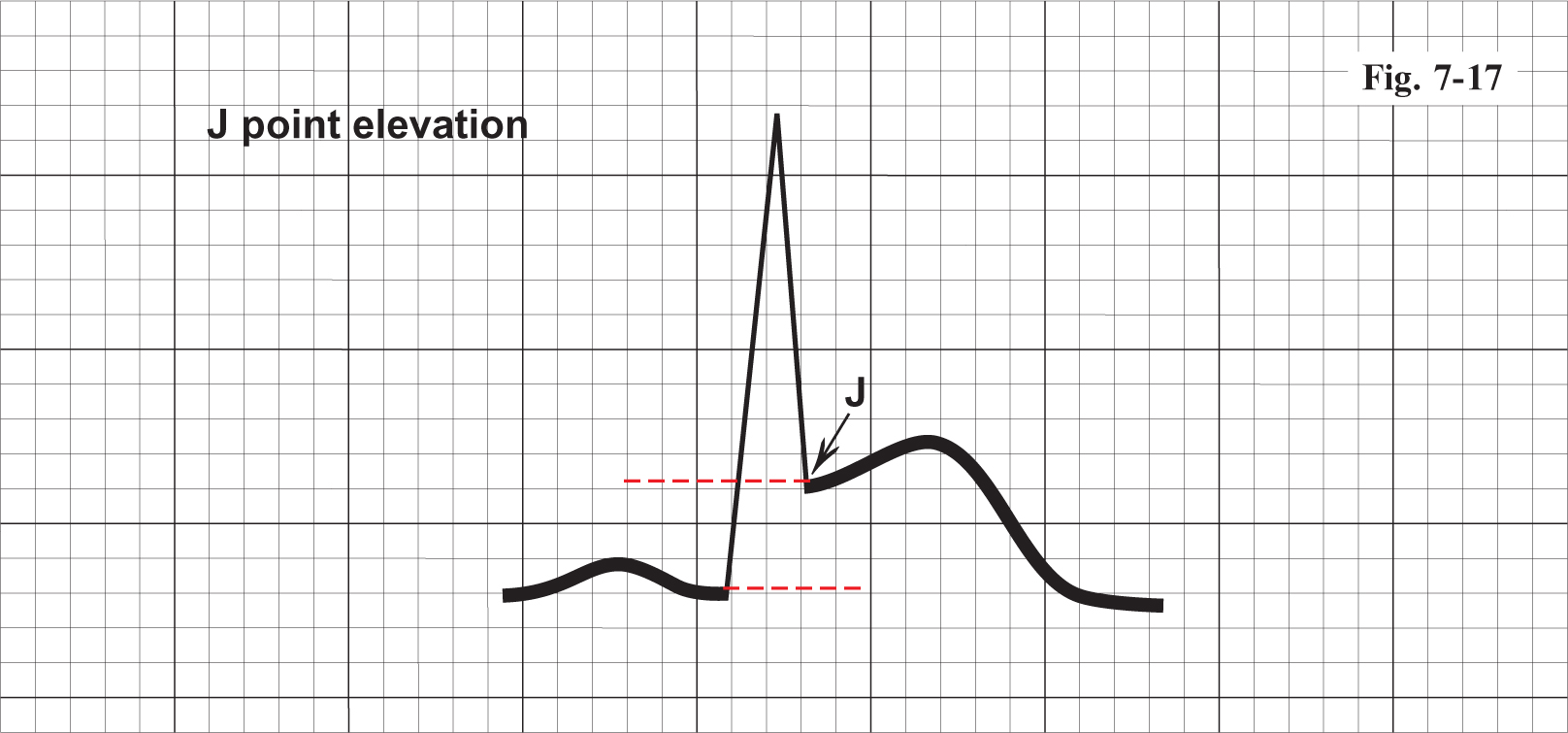 ST Segment Depression (4-Codes) and Negative T-Waves (5-Codes ...