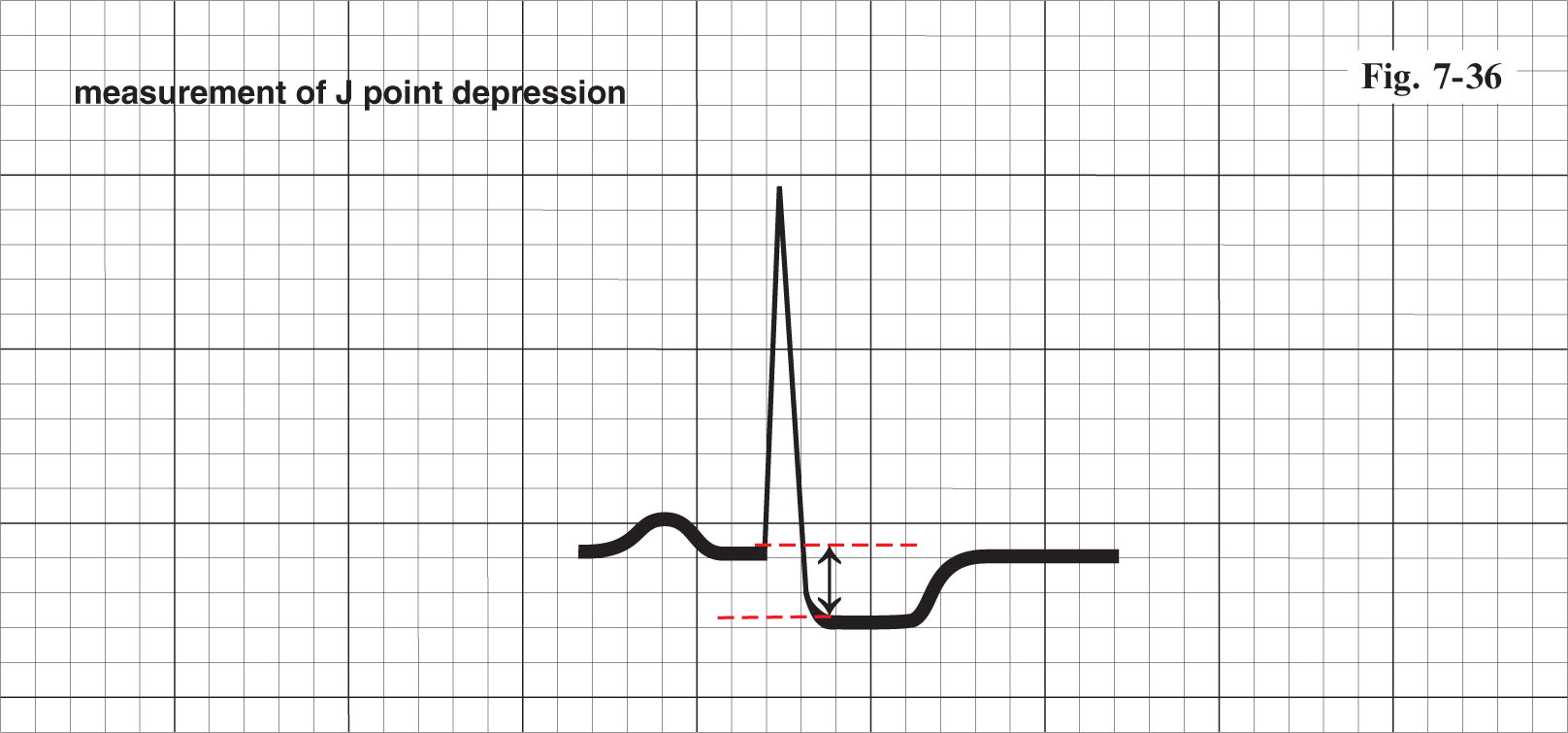 ST Segment Depression (4-Codes) and Negative T-Waves (5-Codes ...