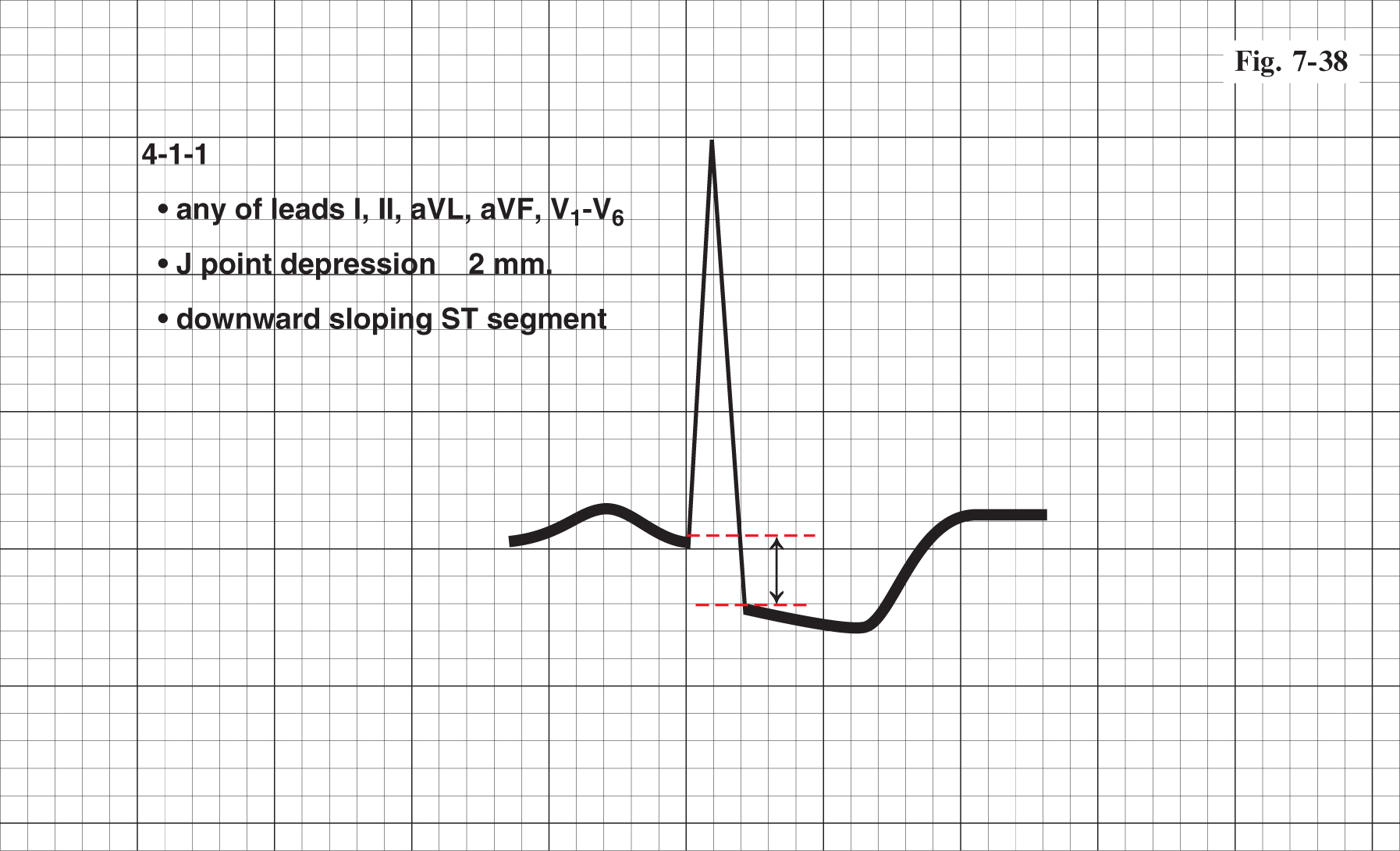 ST Segment Depression (4-Codes) and Negative T-Waves (5-Codes ...