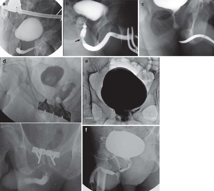 Lower Urinary Tract Trauma | SpringerLink