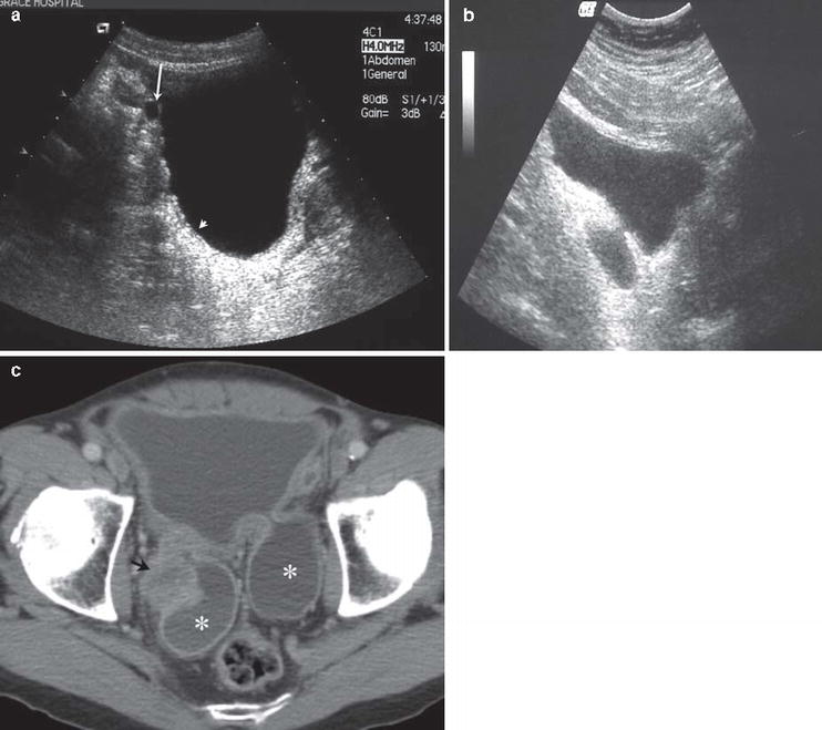 Congenital Anomalies of the Bladder | SpringerLink