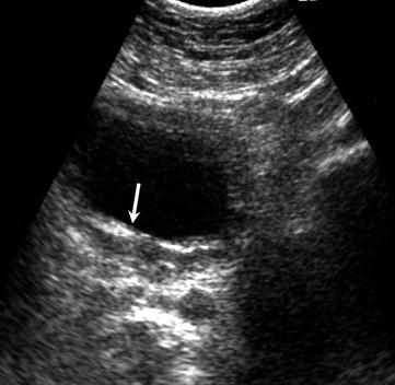 Abnormalities of the Bladder Wall or Mural Abnormalities | SpringerLink