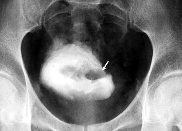 Abnormalities of the Bladder Wall or Mural Abnormalities | SpringerLink