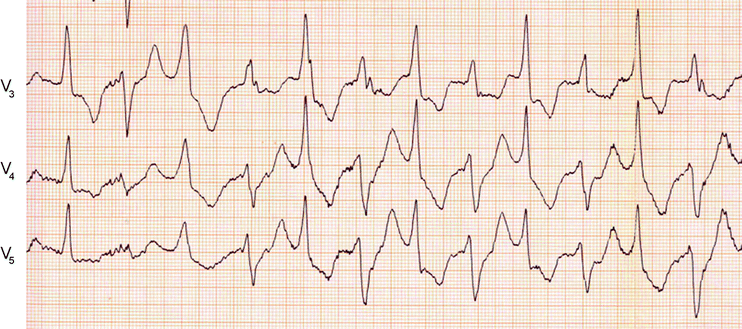 Catecholaminergic Polymorphic Ventricular Tachycardia | SpringerLink