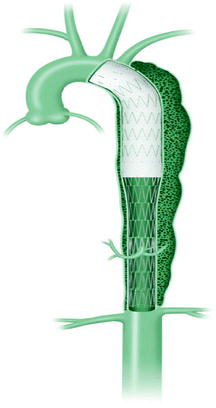 Cook Zenith Dissection Endovascular Stent | SpringerLink