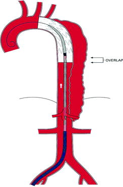 Cook Zenith Dissection Endovascular Stent | SpringerLink