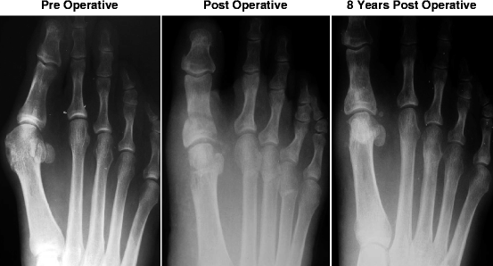 The Reverdin-Isham Procedure for the Correction of Hallux valgus ...