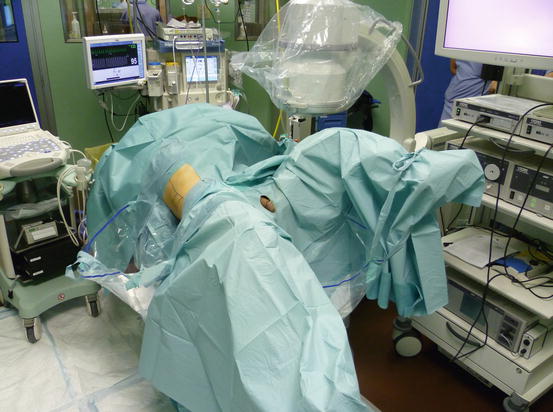 The Scrub Nurse’s Point of View on ECIRS (Endoscopic Combined ...
