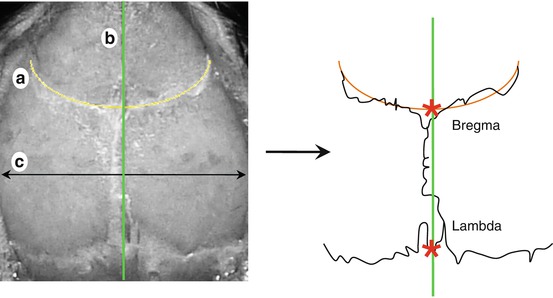 Realization of the Stereotaxic Surgery | SpringerLink