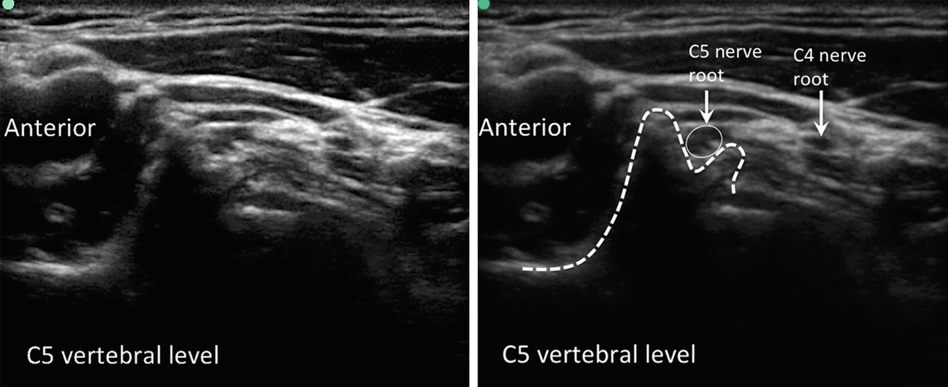 Ultrasound-Guided Cervical Nerve Root Block | SpringerLink