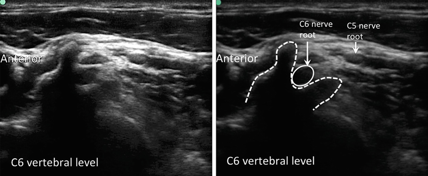 Ultrasound-Guided Cervical Nerve Root Block | SpringerLink