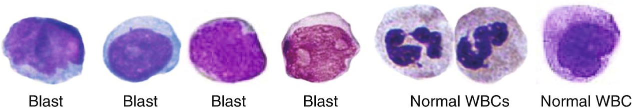 Acute Blast Crisis/Hyperviscosity Syndrome: Blasting Off! | SpringerLink