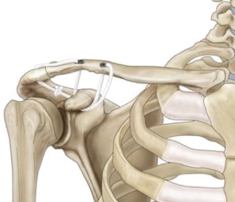 Acromioclavicular Joint Injuries | SpringerLink