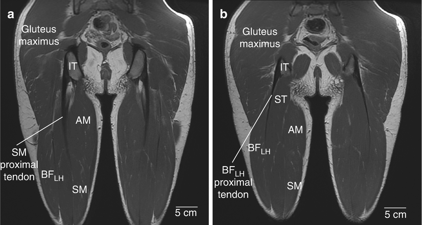 Anatomy of the Hamstrings | SpringerLink