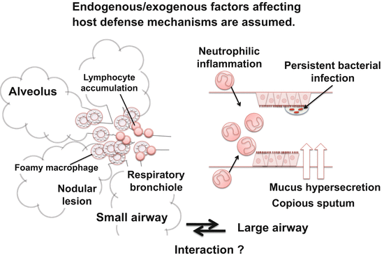 Diffuse Panbronchiolitis | SpringerLink