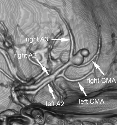 Distal Anterior Cerebral Artery Aneurysms | SpringerLink