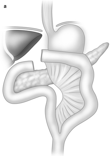 Case on Stenosis of a Side-to-Side Gastrojejunostomy After a ...