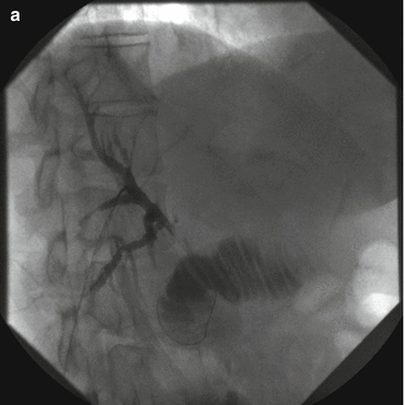 Case on Late Stenosis of Biliodigestive Anastomosis with Cholangitis ...