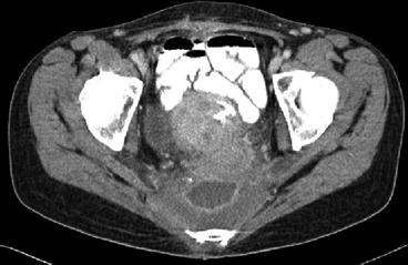 Case on Presacral Abscess and Sinuses After LAR | SpringerLink