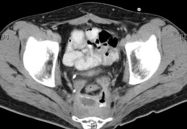Case on Presacral Abscess and Sinuses After LAR | SpringerLink