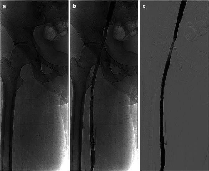 Conventional and Cross-Sectional Venography | SpringerLink