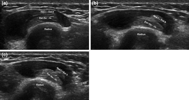 Intersection Syndrome | SpringerLink