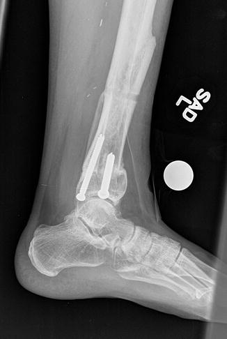 Supramalleolar Dome Osteotomy for Malunion of the Tibia | SpringerLink