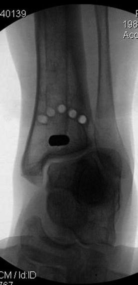 Supramalleolar Dome Osteotomy for Malunion of the Tibia | SpringerLink