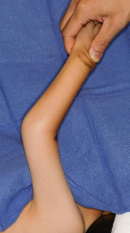 Arthrogryposis Elbow Extension Contracture | SpringerLink