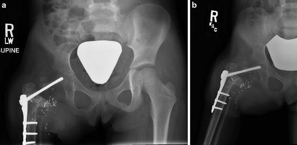 Van Nes Rotationplasty and Hip Reconstruction in the Treatment of ...