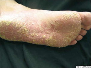 Psoriasis Vulgaris | SpringerLink