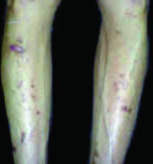 Cutaneous Manifestations of Diabetes Mellitus | SpringerLink