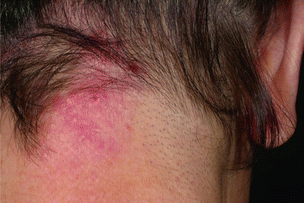 Lichen Simplex Chronicus | SpringerLink