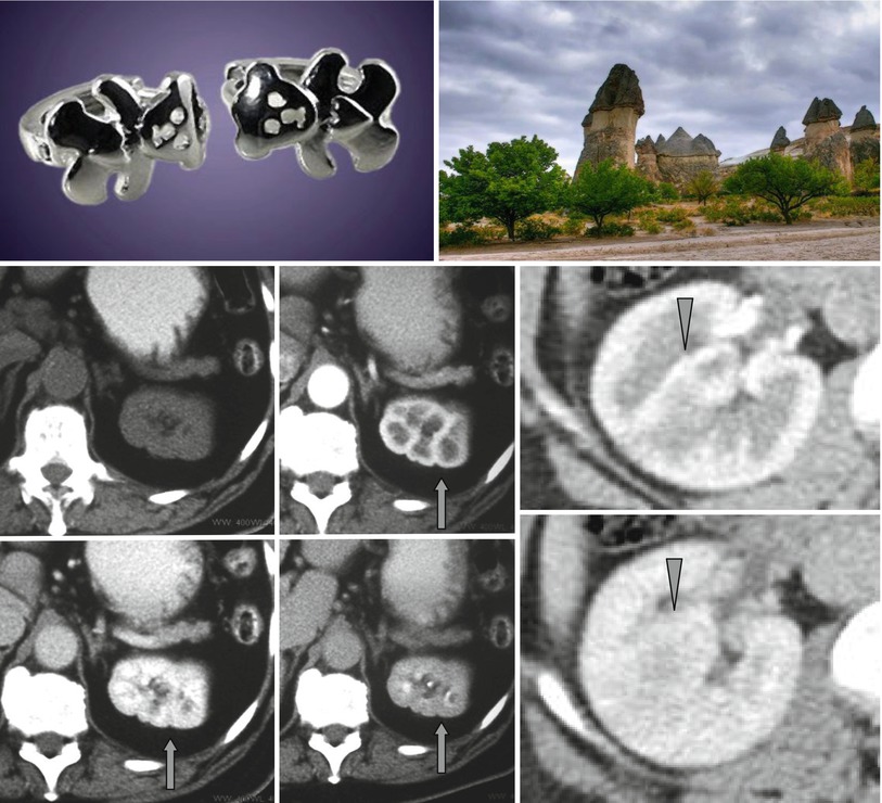 Fetal Lobulation or Lobation and Column of Bertin Hypertrophy ...