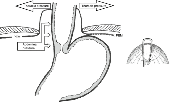 Gastroesophageal Reflux Disease: Pathophysiology | SpringerLink